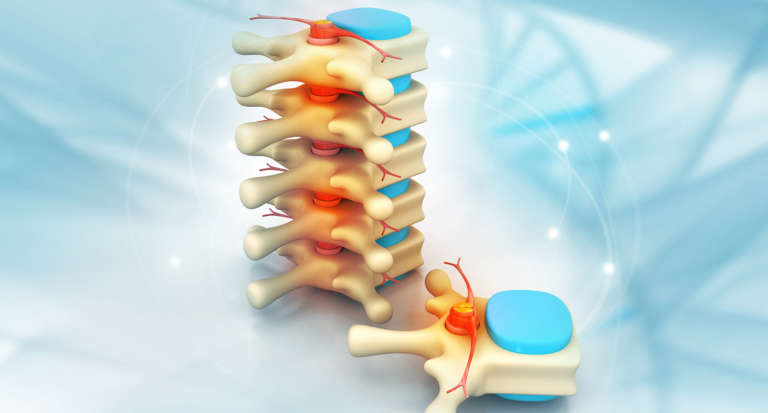 Disk Decompression – Results Chiropractic